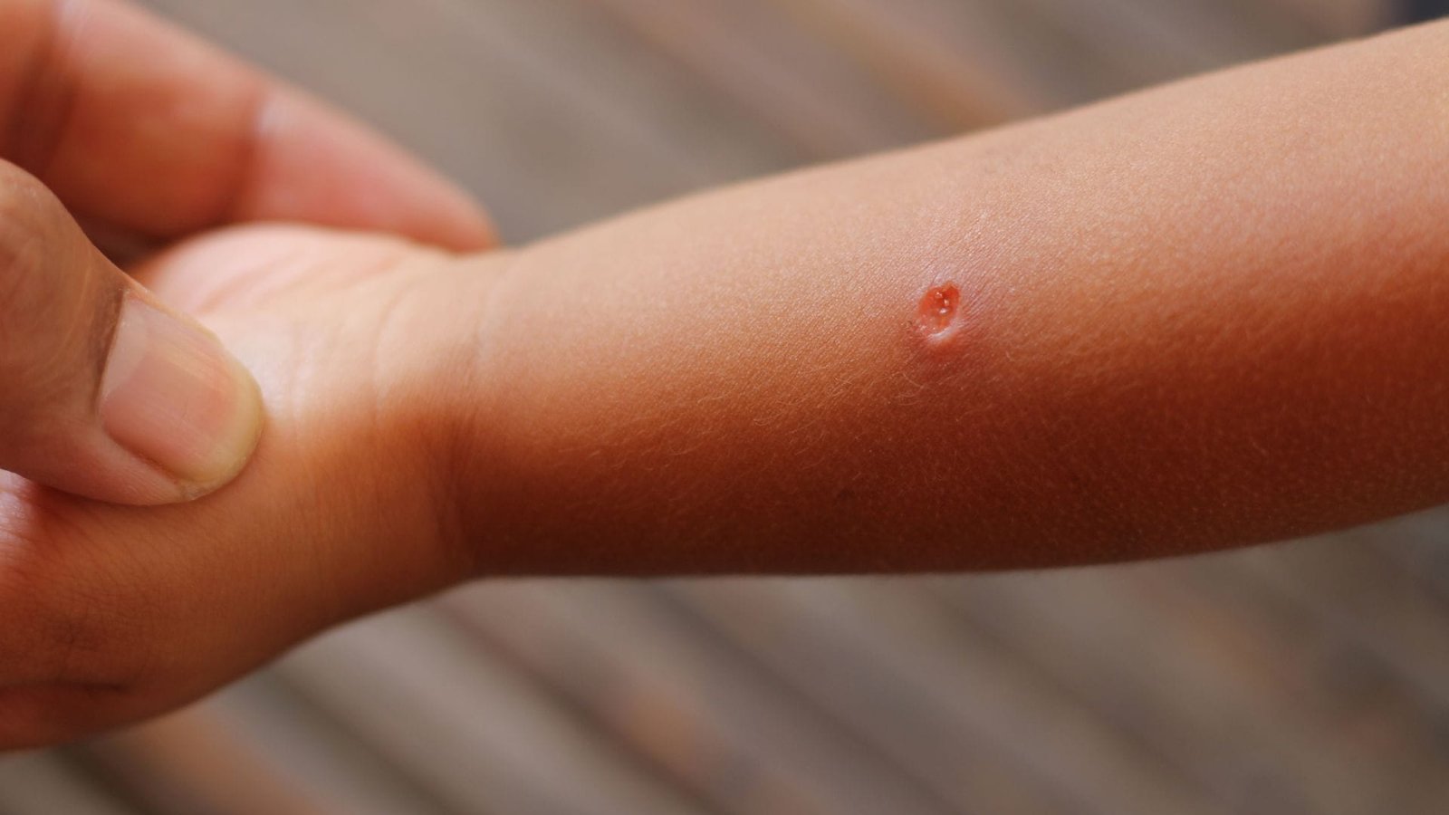 Picadas de insetos em bebês: o que passar para tratar